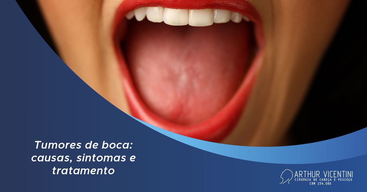 Tumores de boca: causas, sintomas e tratamento - Dr. Arthur Vicentini ...