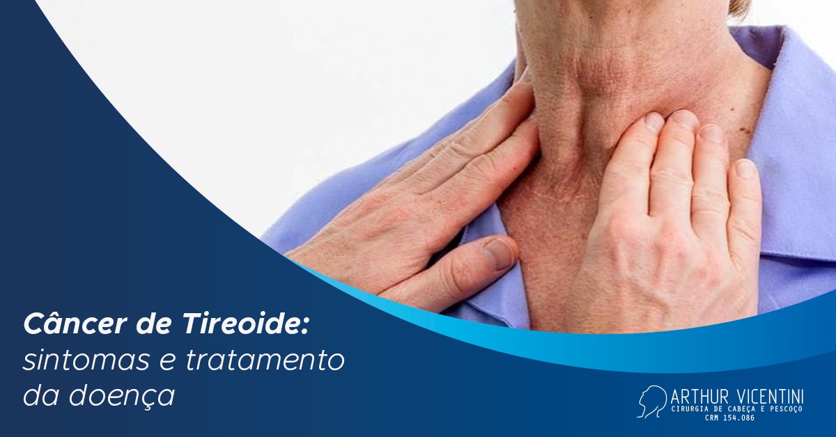 Câncer de Tireoide: sintomas e tratamento da doença - Dr. Arthur ...