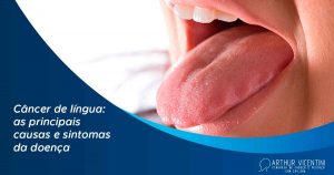 Câncer De Língua: As Principais Causas E Sintomas Da Doença - Dr ...