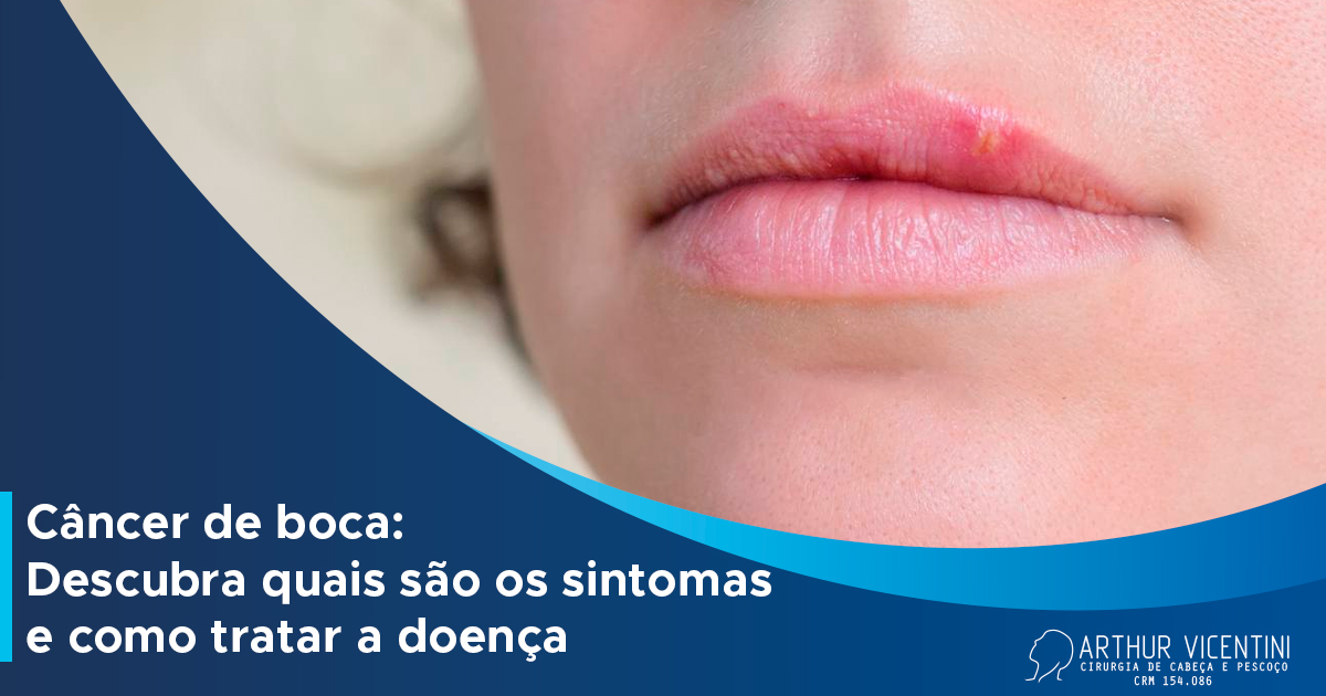 Câncer de boca: descubra quais são os sintomas e como tratar a doença ...