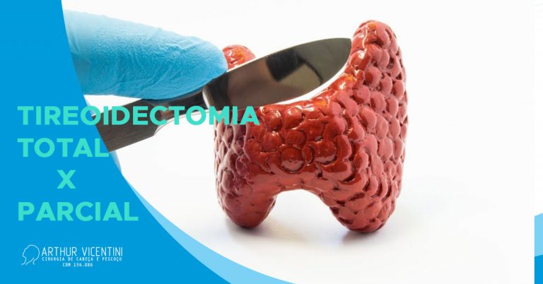 Tireoidectomia Total X Tireoidectomia Parcial - Dr. Arthur Vicentini ...