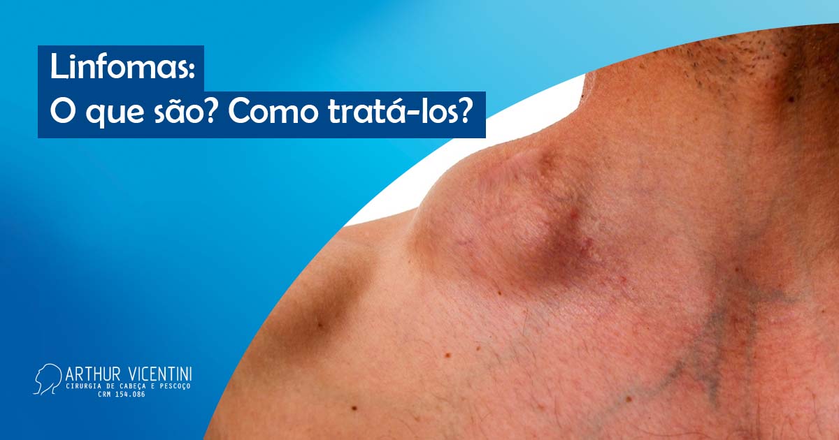 Linfomas: O Que São? Como Tratá-los? - Dr. Arthur Vicentini CRM-SP 154086
