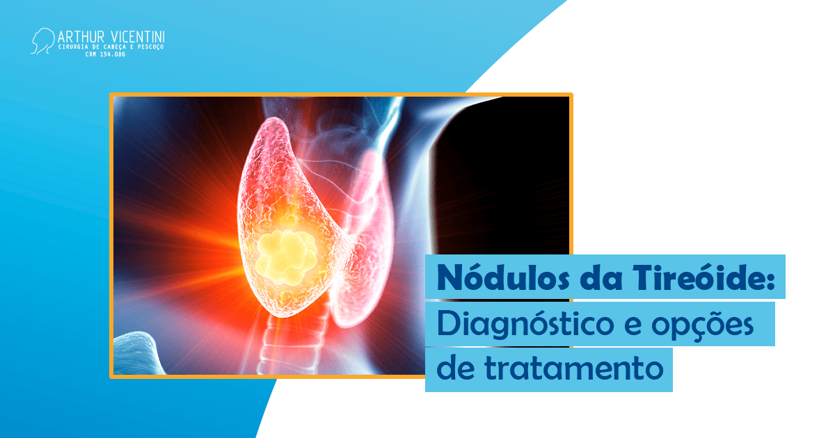 Biopsia De Nodulos De Tireoide Sintomas De Nódulo Na Tireoide