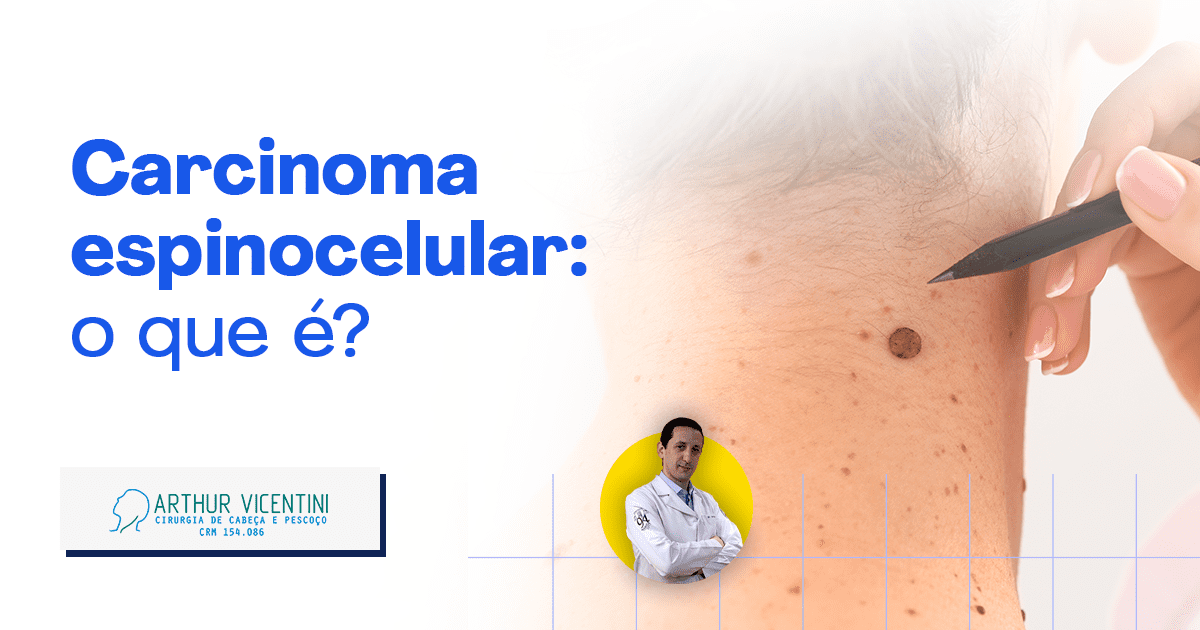 Carcinoma Espinocelular: O Que é? - Dr. Arthur Vicentini CRM-SP 154086
